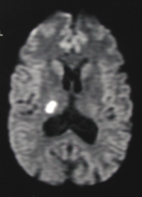 후대뇌동맥 경색posterior Cerebral Artery Territory Infarction 정상 기능 증상 예후